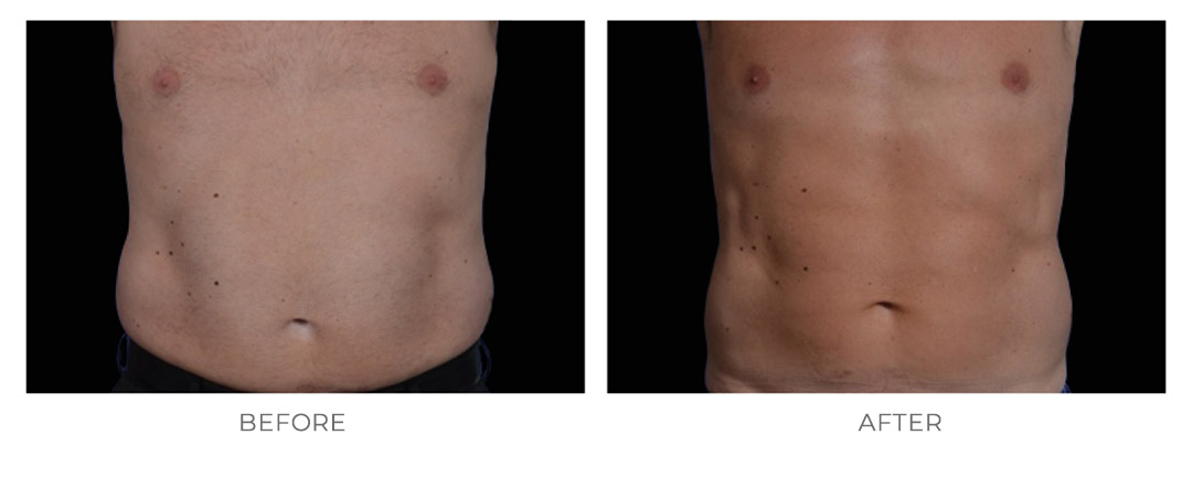 Before & After Emsculpt – Newport Coast Dermatology